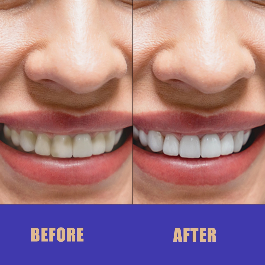 Most Natural Looking Veneers For Broken Teeth